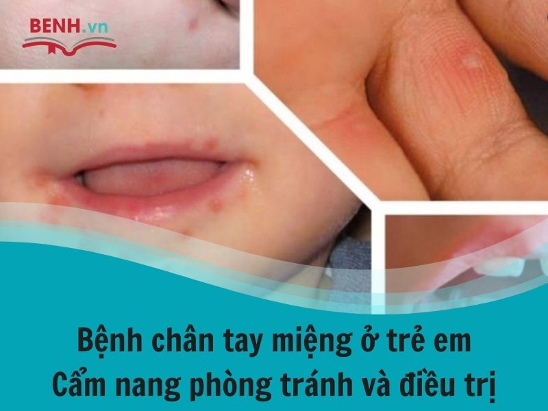 Bệnh chân tay miệng ở trẻ em: Cẩm nang phòng tránh và điều trị - Benh.vn