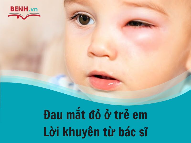 Đau mắt đỏ ở trẻ em: Lời khuyên từ bác sĩ - Benh.vn