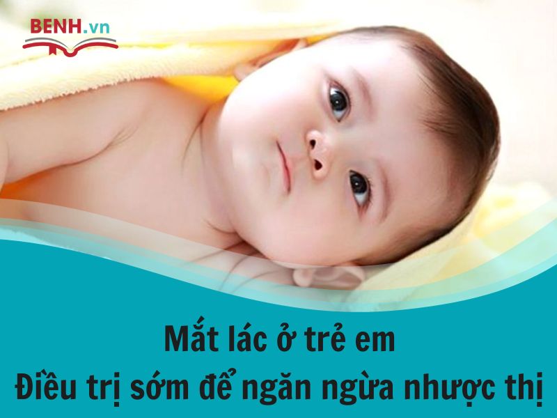 Mắt lác ở trẻ em: Điều trị sớm để ngăn ngừa nhược thị