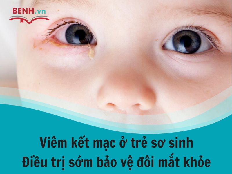 Viêm kết mạc ở trẻ sơ sinh: Điều trị sớm bảo vệ đôi mắt khỏe